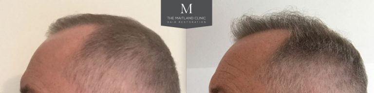 2 weeks after hair transplant: returning to work (post-op FUE recovery)