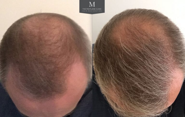 2 weeks after hair transplant: returning to work (post-op FUE recovery)