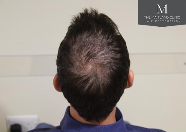 1349 Grafts By Fue The Maitland Clinic