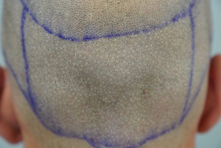 Does an FUE hair transplant leave scars? + 5 Common FUE Questions