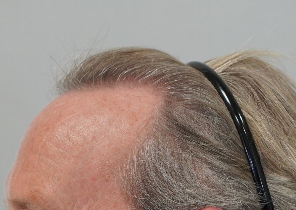 1454 grafts by FUE - The Maitland Clinic