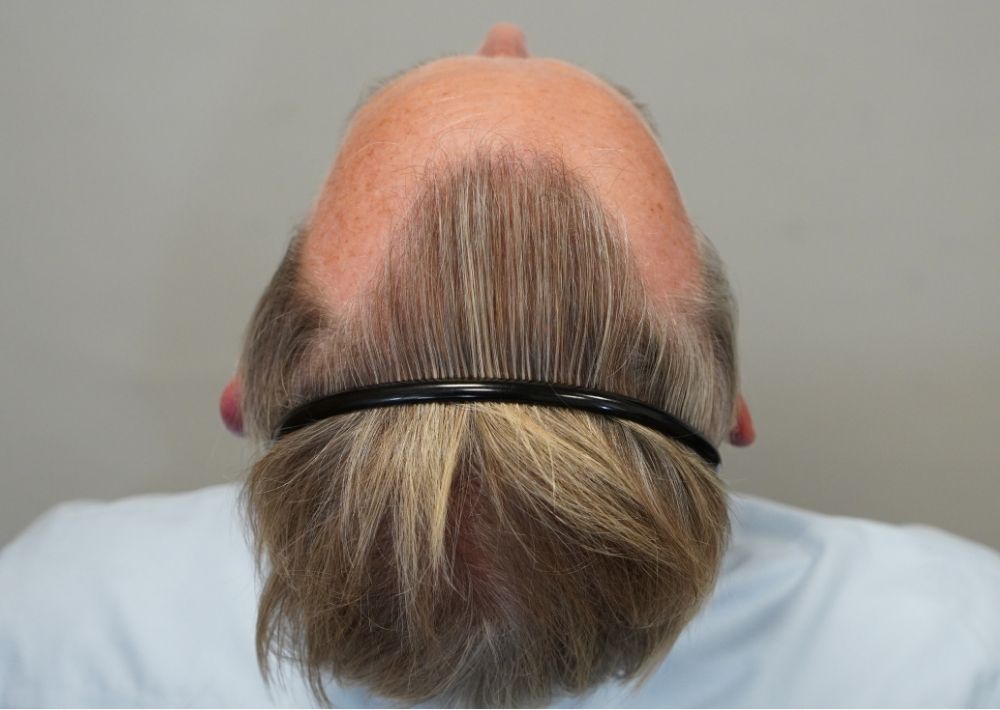 1454 grafts by FUE - The Maitland Clinic